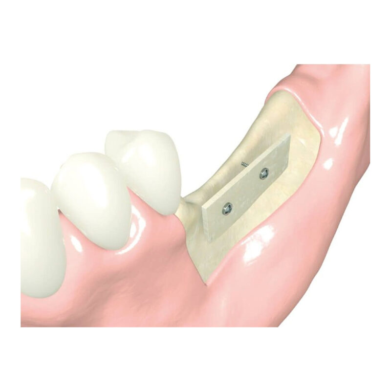 Cortical Plate - syntetyczna, resorbowalna płytka kortykalna - 25x10x1 ...